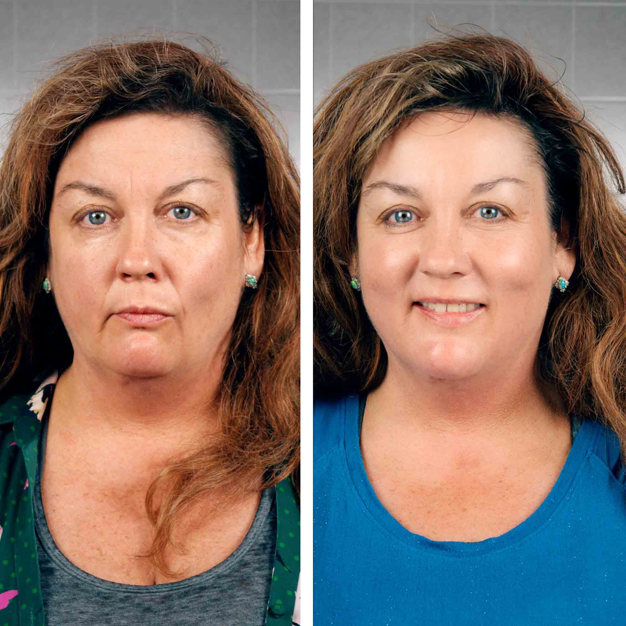 Webclass: how to get rid of wrinkles - Derma Made